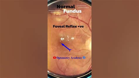 Normal Fundus Normal Retina Smartphone Fundus Videography Fundus