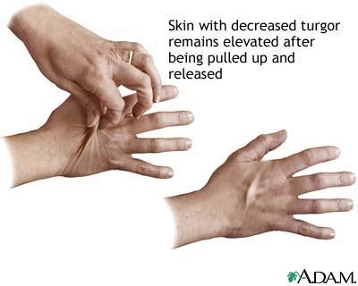 Skin Turgor Medlineplus Medical Encyclopedia Image