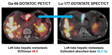 Prediction Of Absorbed Dose By Tumors And Critical Organs After Lu 177