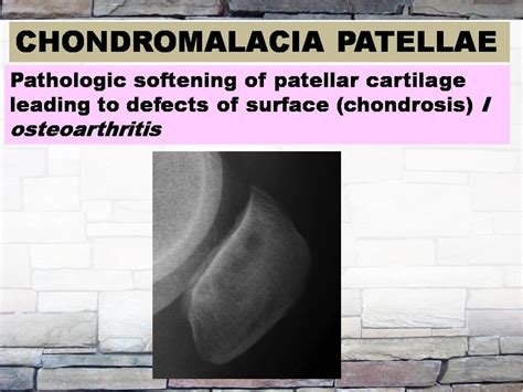 Chondromalacia Patellae Radiology Classroom