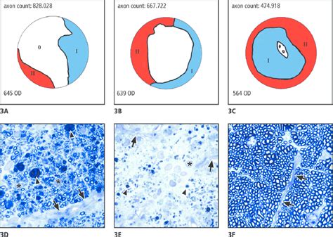 Morphology Of Optic Nerve Damage As A Result Of Expg Ac Schematic