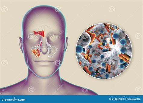 Sinusitis Inflammation Of Paranasal Cavities And Close Up View Of Bacteria Royalty Free