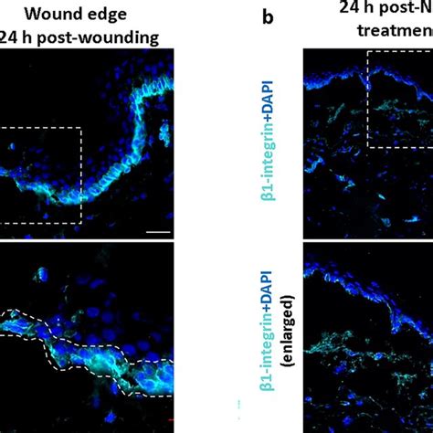 β1 Integrin Expression Of Basal Keratinocytes Is Increased In Ex Vivo