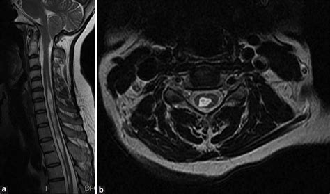 Arachnoiditis Its Causes Symptoms Types And Treatment Page 2 Healthzap