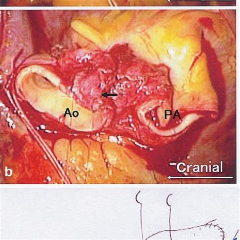 Intraoperative Photos Show The Cut Left Aortic Sinus And The Left Main Download Scientific