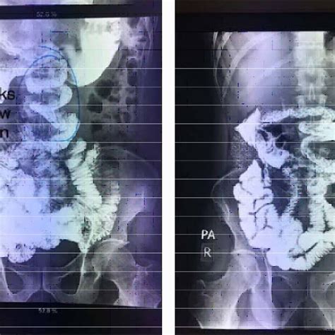 Barium Follow Through Show Intestinal Malrotation Download