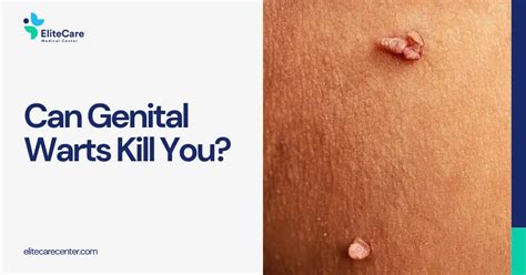 Can Genital Warts Kill You