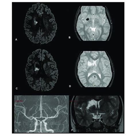 Acute Right Basal Ganglia Infarct Magnetic Resonance Mr Findings