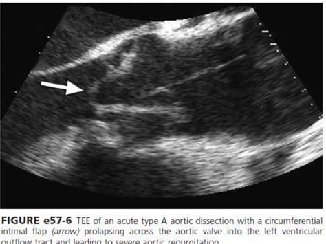 Aortic Dissection Ppt Pptx