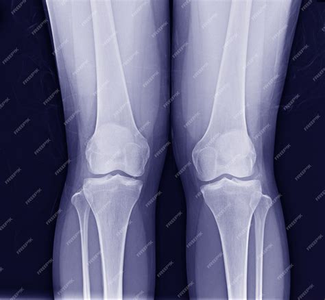 Radiografía De Rodilla Foto Premium