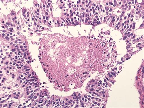 Small Foci Of Coagulative Necrosis Were Also Observed Hematoxylin And Download Scientific