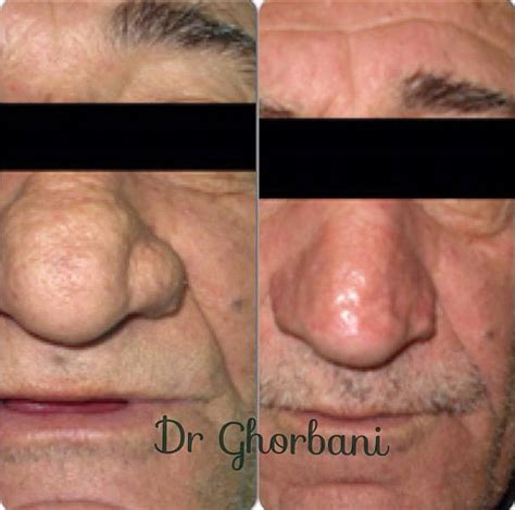 Laser For Rhinophyma Rhinoplasty Cost Pics Reviews Qanda
