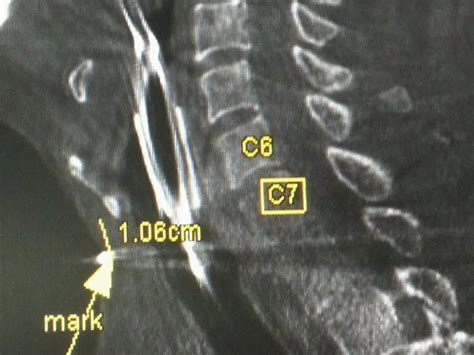 关靖宇教授：国内神经外科第一例颈7神经移位治疗偏瘫手术 脑医汇 神外资讯 神介资讯