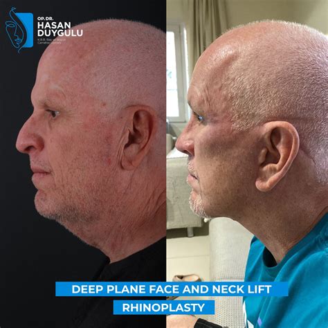 Deep Plane Facelift In Turkey Istanbul Dr Hasan Duygulu