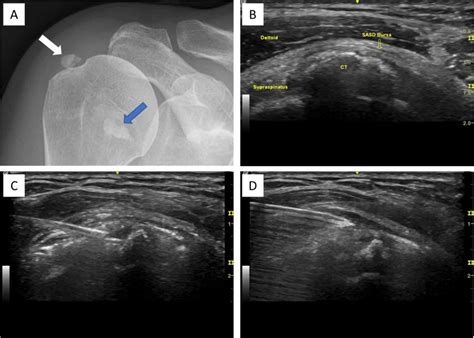 Ac Joint Calcification Ultrasound At Callum Ardill Blog