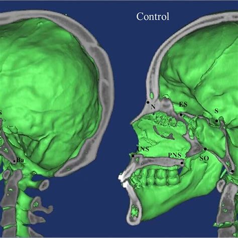 The Anatomical Landmarks Were Shown On The Computed Tomographic Scans Download Scientific