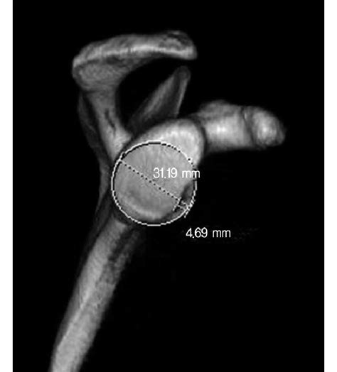 Measurement Of Glenoid Bone Defect Using 3d Ct Download Scientific Diagram