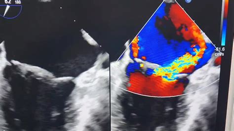 Mohamed Elsabah On Linkedin 39 Year Old Lady With Nyha Class Iii Sob Severe Mr And Pml