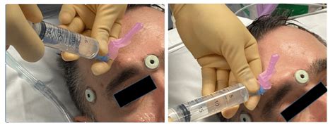 Scalp Block Technique And Applications Virtual Library