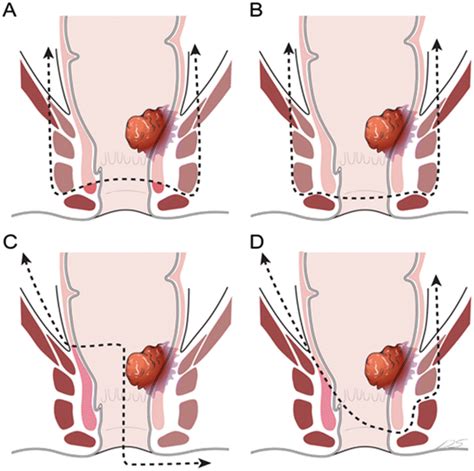 Intersphincteric Resection And Coloanal Reconstruction Oncohema Key