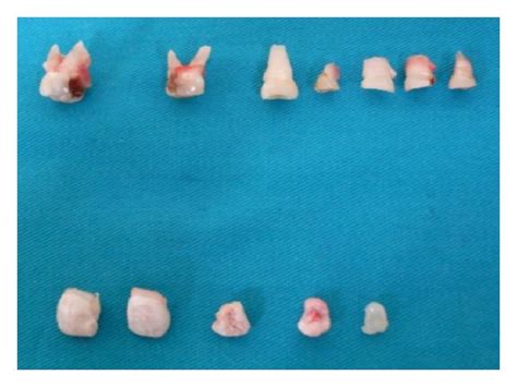 Postsurgical Photographs Showing Extracted Teeth A Maxillary