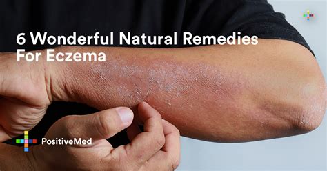 6 Wonderful Natural Remedies For Eczema Positivemed