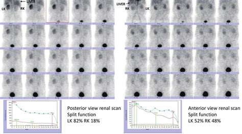 A The Split Function Calculated By Tc 99m Dtpa Renal Scan In Download Scientific Diagram