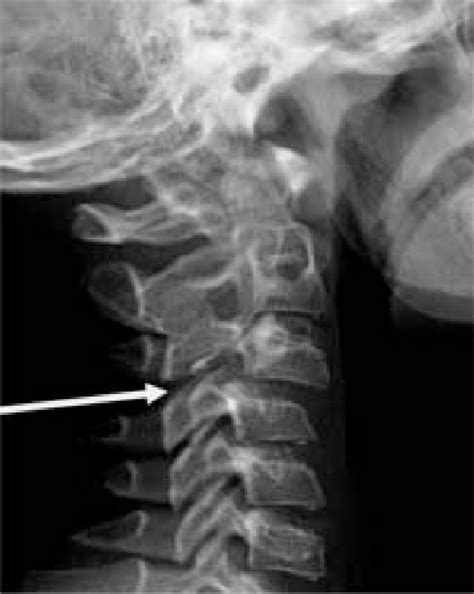 Figure 1 From C3 C4 Unilateral Facet Fracture Dislocation With