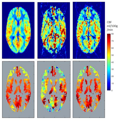 Left The Cbf Map Top Row And Gray Matter Partial Volume Corrected