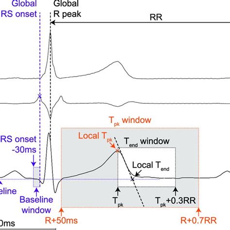 Illustration Of Global Qrs Onset And Local T Wave Landmarks Detection