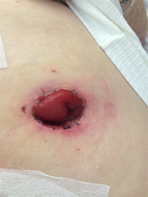 A Case Of Surgically Treated Peristomal Pyoderma Gangrenosum In A Patient With Rheumatoid