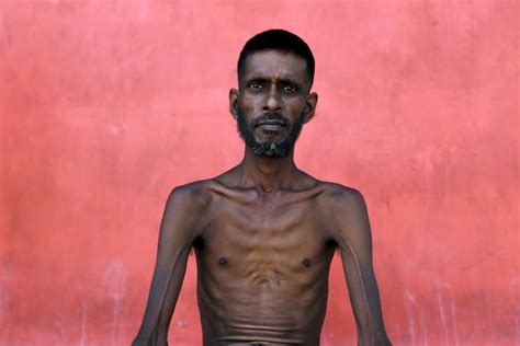 They Are Becoming Skin And Bones