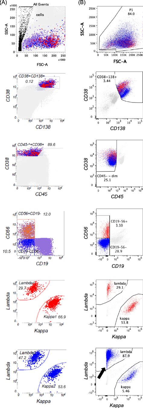 Detection Of Clonal Plasma Cells In Poems Syndrome Using Multiparameter Flow Cytometry