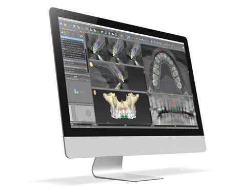 Digital Dental Implant Planning Software Patient Communication Tools