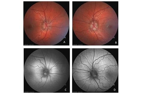 Optic Neuritis Vs Normal