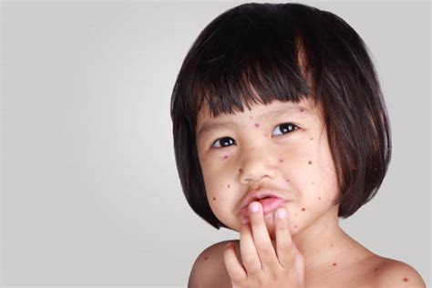 Smallpox Types Symptoms And Treatment Siddha Spirituality For Health