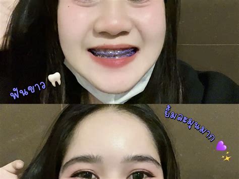 รีวิว สียางจัดฟันสีม่วง ที่จริงใจ💜 🦷 แกลเลอรีที่โพสต์โดย Eeeeensur
