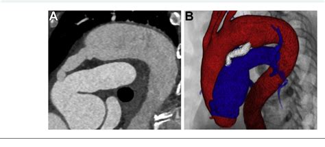 Figure 1 From Acute Aortic Dissection As A Rare Complication Of Percutaneous Closure Using The