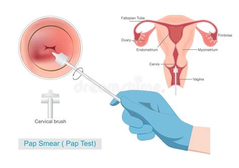 Cervical Cancer Screening By Sampling The Endocervix Stock Vector