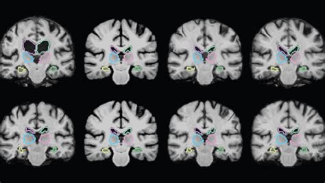 Algorithm Enables Faster Analysis Of Medical Images Tech Briefs