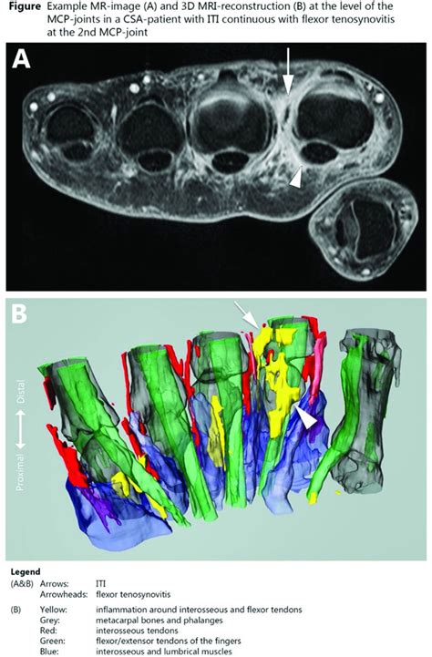 Interosseous And Lumbrical Muscles