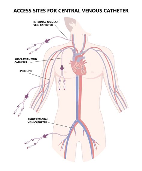 How To Draw Blood From Midline Catheter