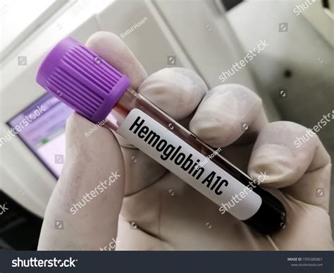 376 Hemoglobin A1c Images Stock Photos Vectors Shutterstock