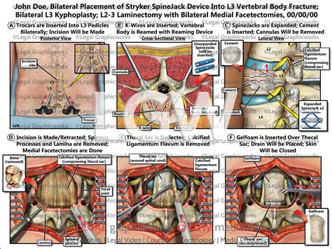 Bilateral Placement Of Stryker Spinejack Device Into L3 Vertebral Body