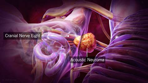 Acoustic Neuroma Vestibular Schwannoma Diagnosis Treatment