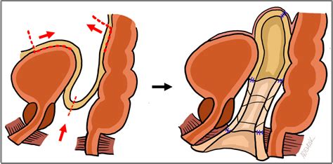 Technical Considerations For Neovaginal Canal Creation During Primary