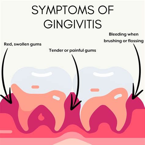 Gingivitis Pregnancy At Sally Seim Blog