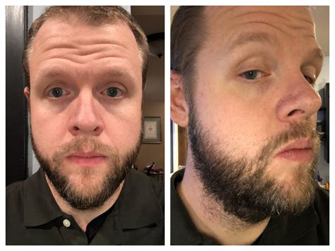 Kept A Short Beard 2 Guard On The Clippers For About A Year