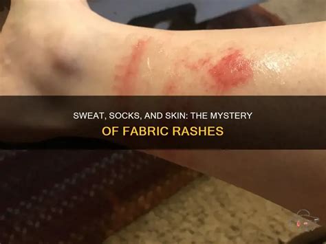 Sweat Socks And Skin The Mystery Of Fabric Rashes ShunVogue