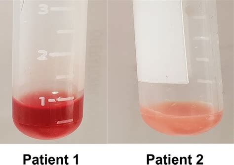 Educational Case Hemolysis And Lipemia Interference With Laboratory